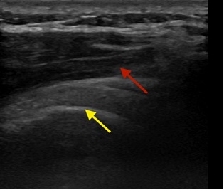 ΝΟΣΟΣ ΠΕΤΑΛΟΥ ΣΤΡΟΦΕΩΝ ΩΜΟΥ - ΣΥΝΔΡΟΜΟ ΥΠΟΑΚΡΩΜΙΑΚΗΣ ΠΡΟΣΤΡΙΒΗΣ ...
