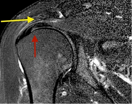 ΝΟΣΟΣ ΠΕΤΑΛΟΥ ΣΤΡΟΦΕΩΝ ΩΜΟΥ - ΣΥΝΔΡΟΜΟ ΥΠΟΑΚΡΩΜΙΑΚΗΣ ΠΡΟΣΤΡΙΒΗΣ ...