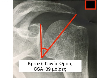 ΝΟΣΟΣ ΠΕΤΑΛΟΥ ΣΤΡΟΦΕΩΝ ΩΜΟΥ - ΣΥΝΔΡΟΜΟ ΥΠΟΑΚΡΩΜΙΑΚΗΣ ΠΡΟΣΤΡΙΒΗΣ ...