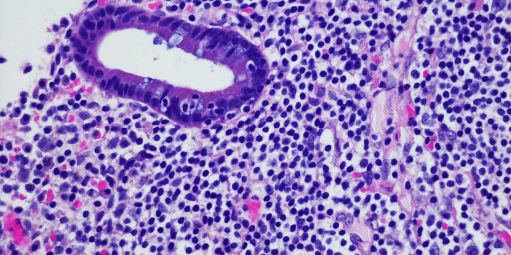 A biomarker for lymphoma development in Sjogren's syndrome: Salivary ...